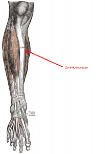 La périostite tibiale - Doc Brice Bellemans